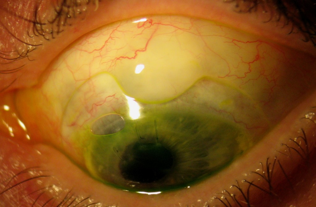 scleral-notch-21 - The Scleral Lens Center